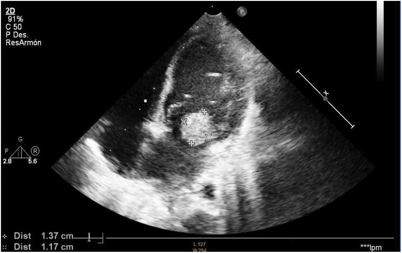 infective endocarditis echo report