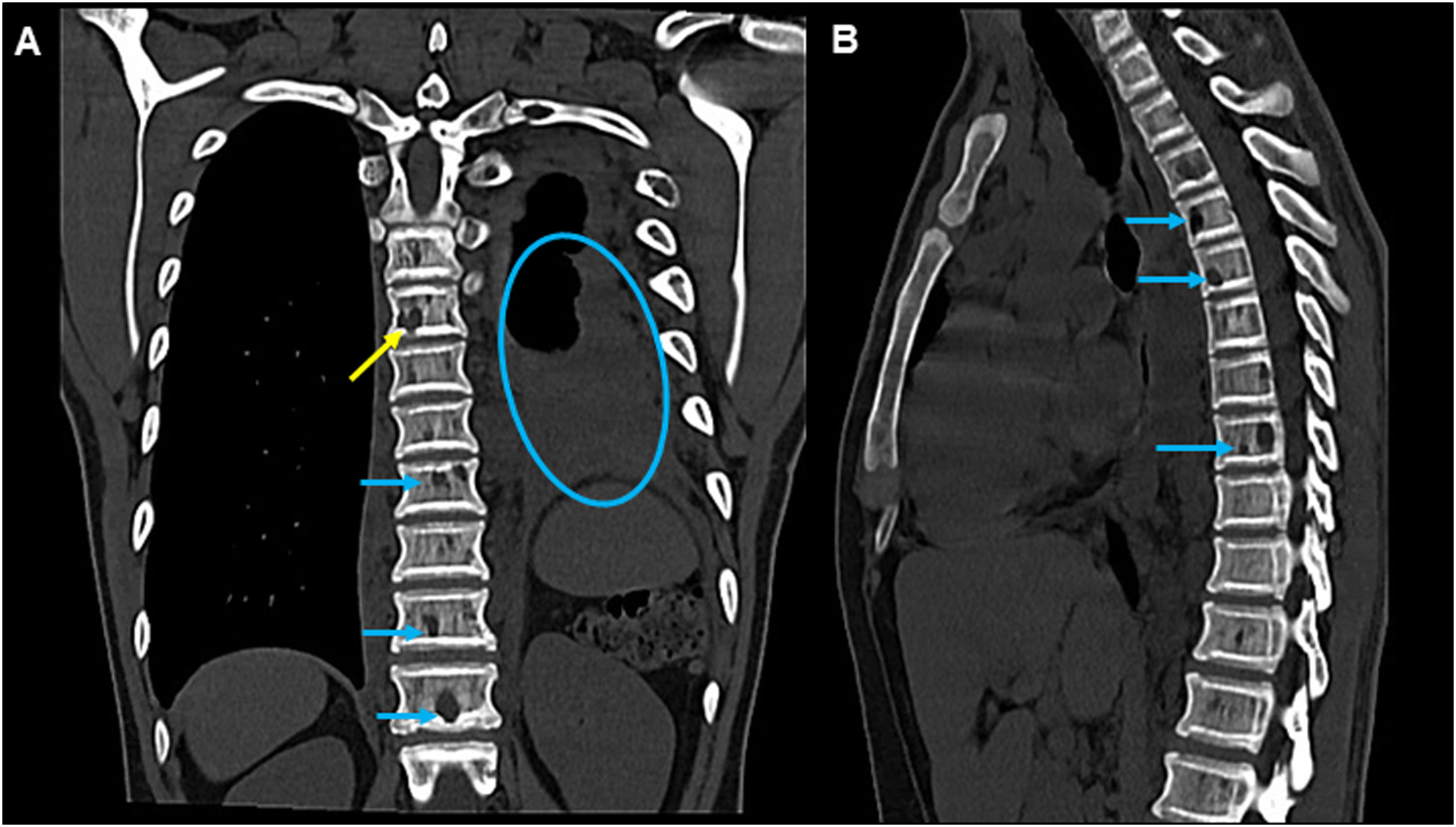 Gorham-Stout syndrome: a rare cause of osteolytic lesions | Anales de ...