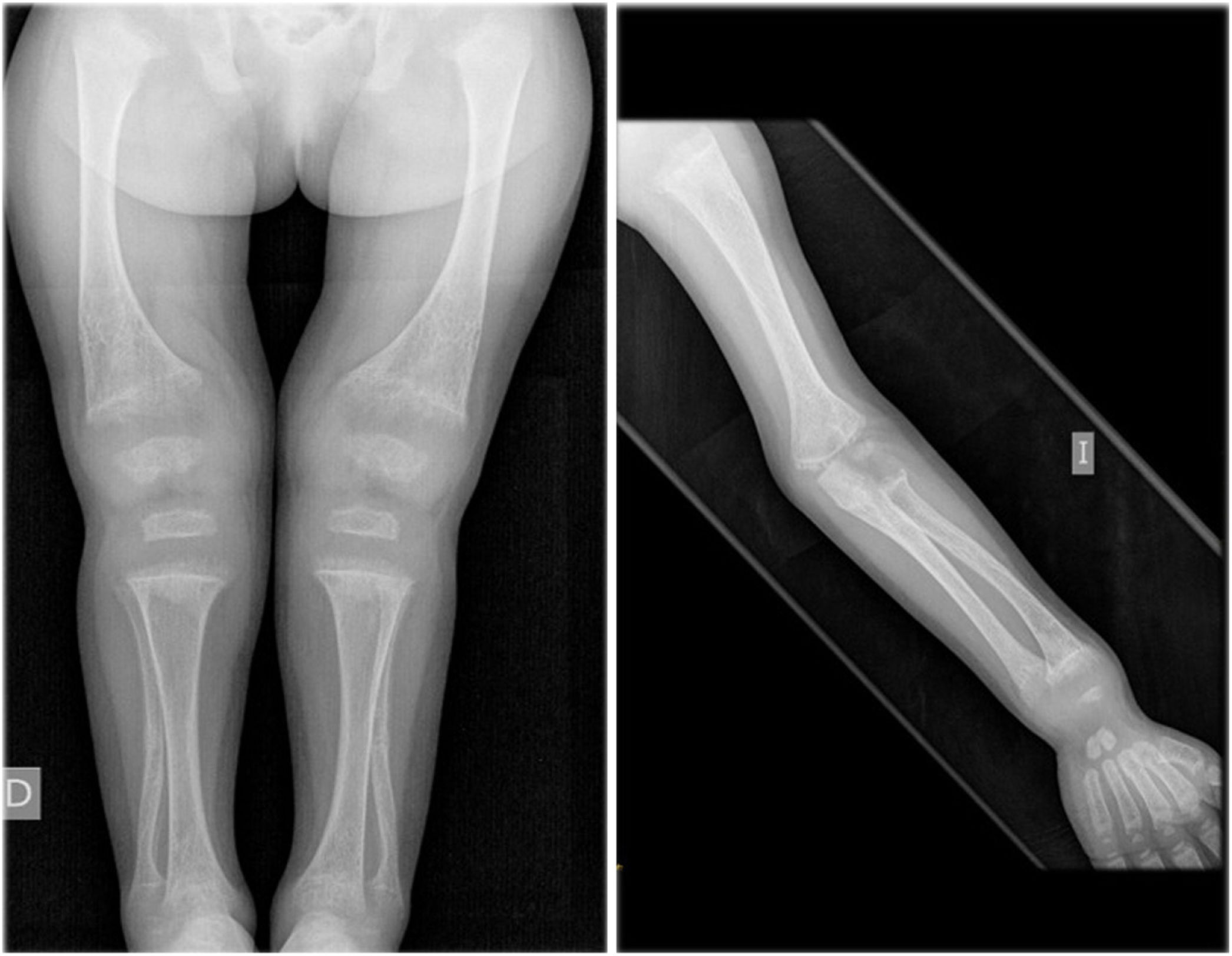 rickets bone findings