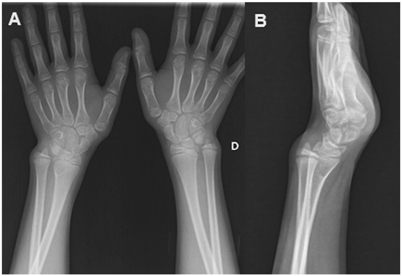 Madelung deformity | Anales de Pediatría