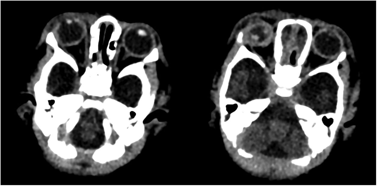 Corneal perforation. A rare complication of birth trauma | Anales de ...