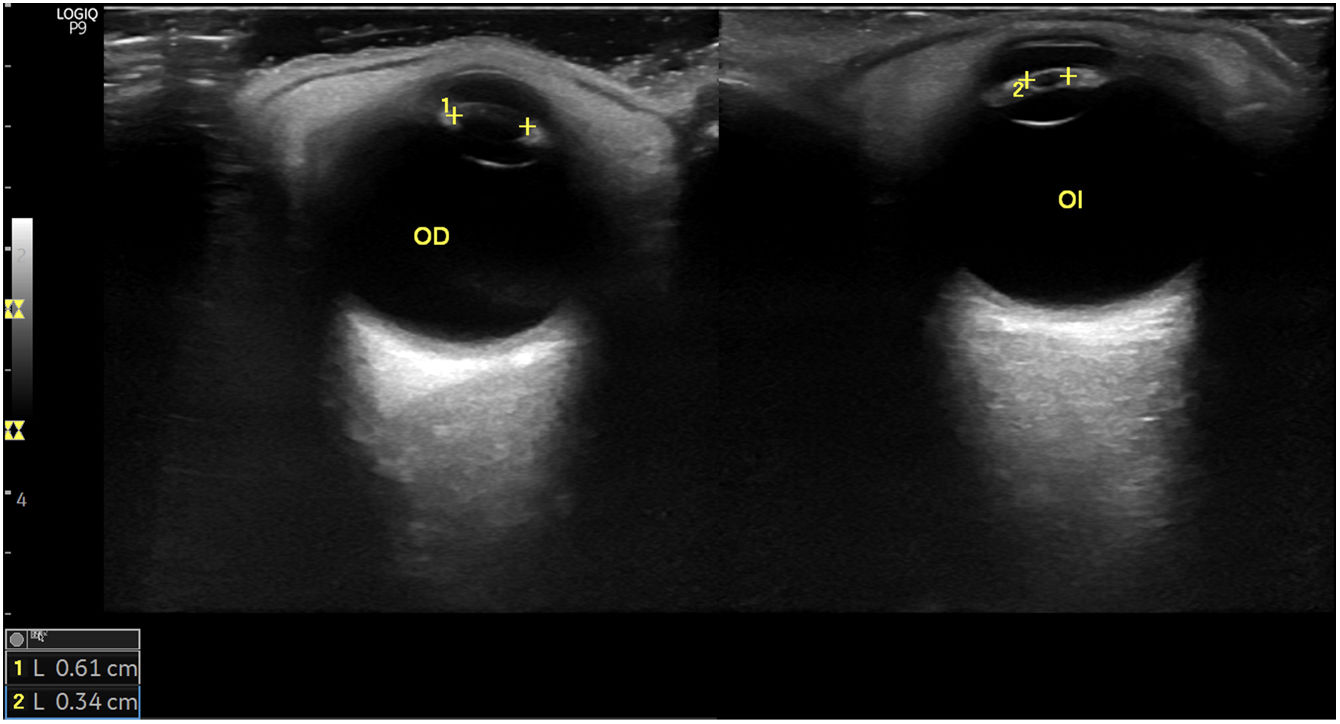 Ultrasound diagnosis of anterior uveitis in primary care | Anales de ...