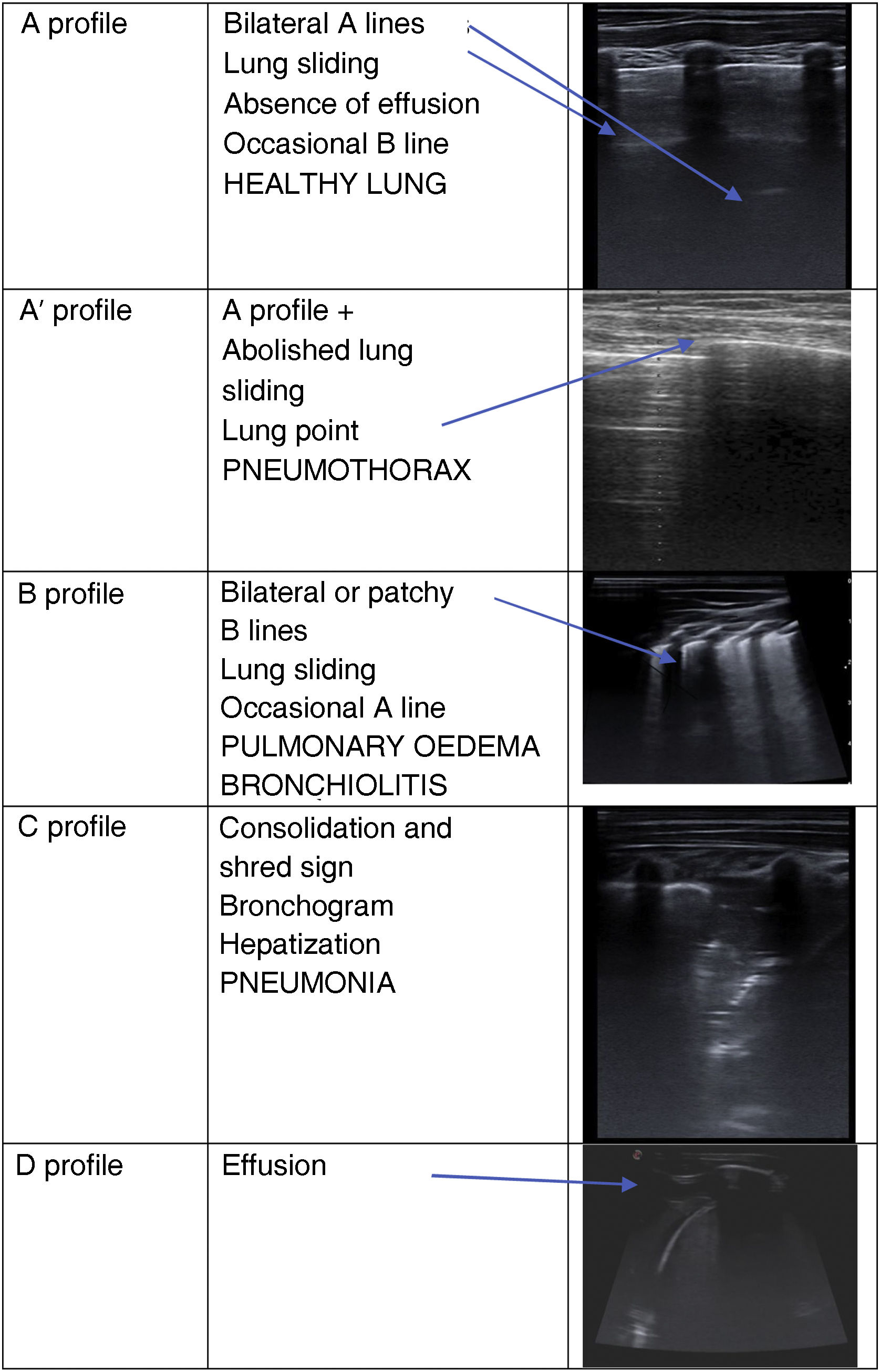 lung sliding pocus