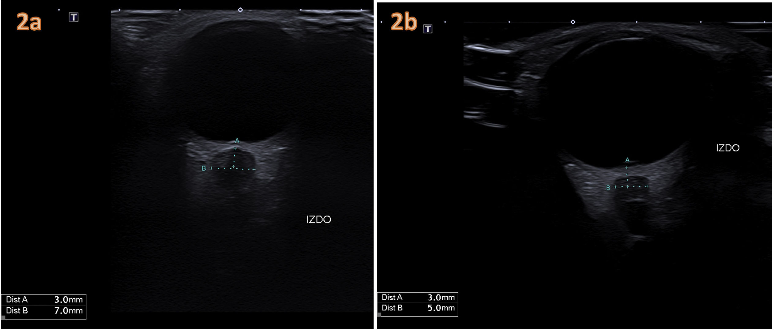 optic nerve diameter normal