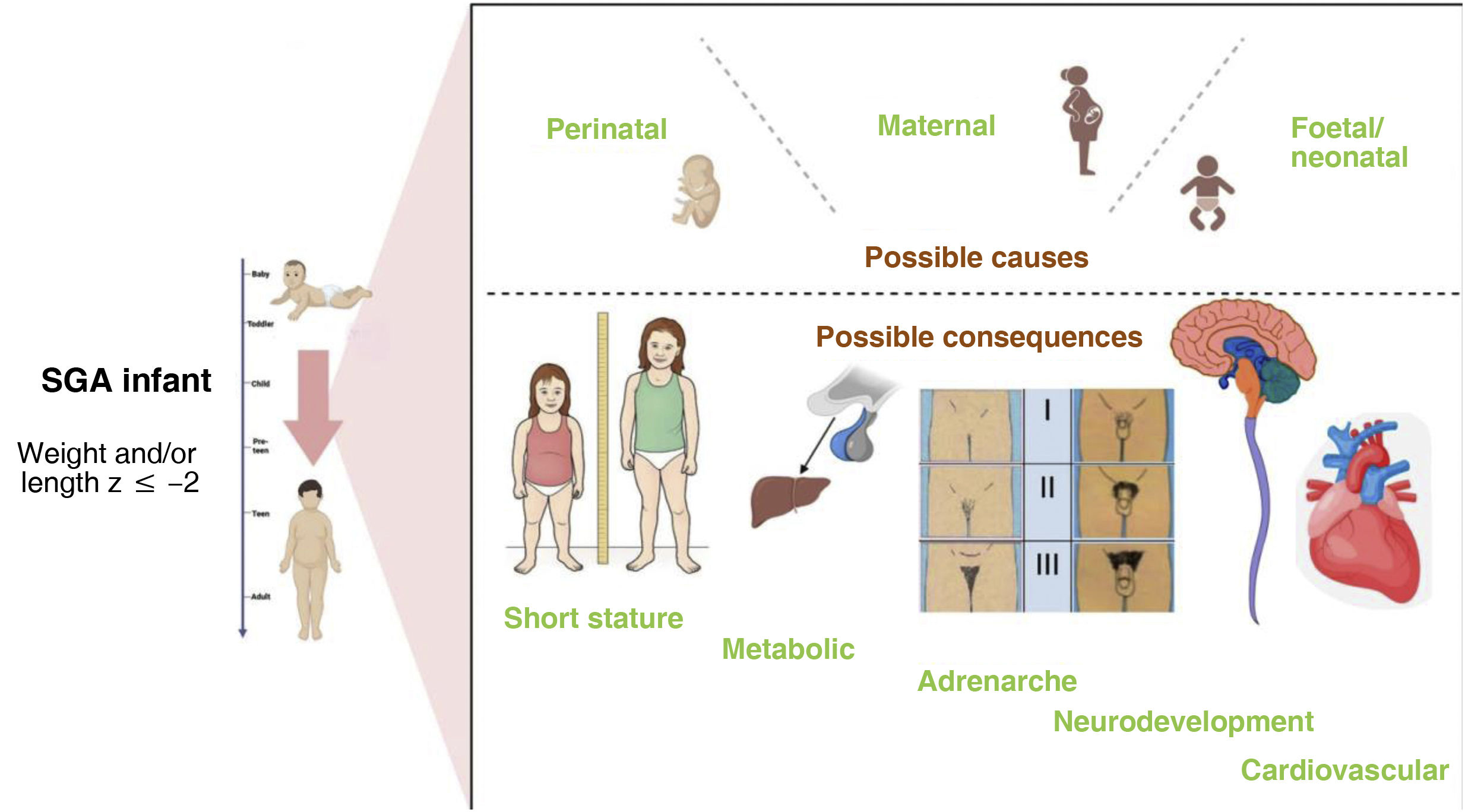 Small for gestational age: concept, diagnosis and neonatal ...