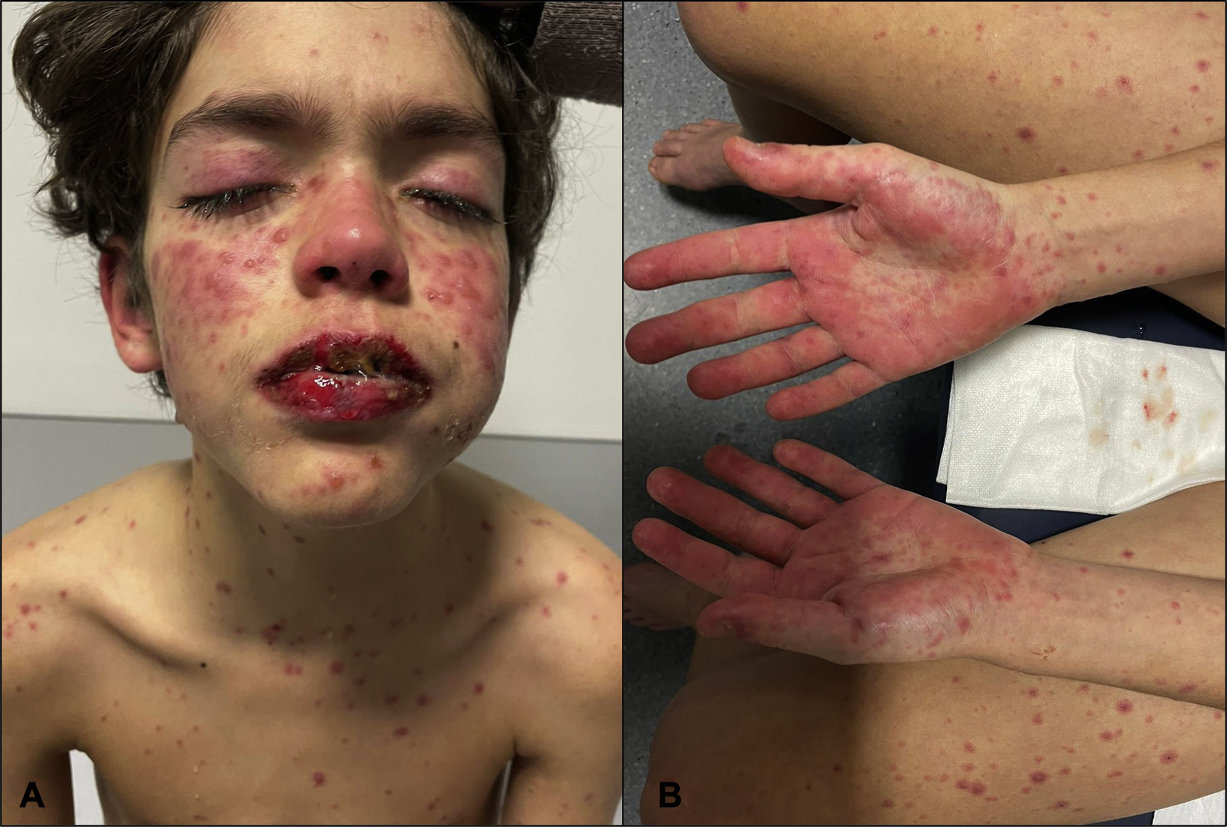erythema multiforme