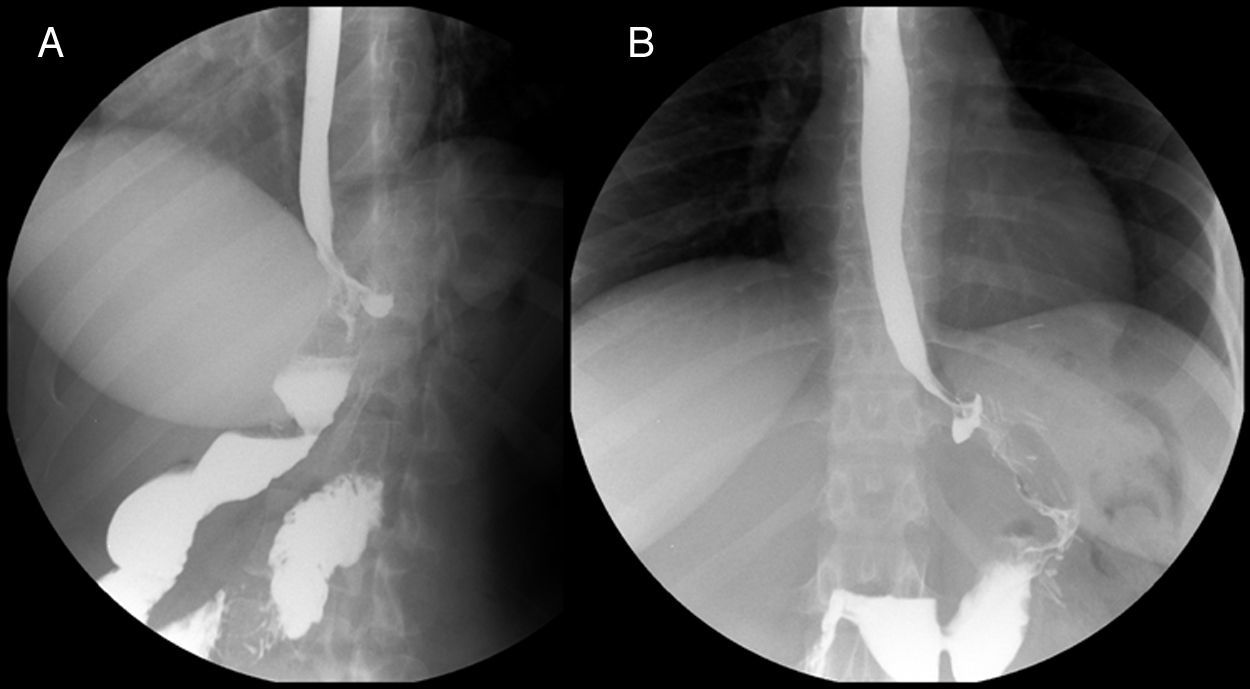 Endoscopic Treatment of Early Gastric Obstruction After Sleeve ...