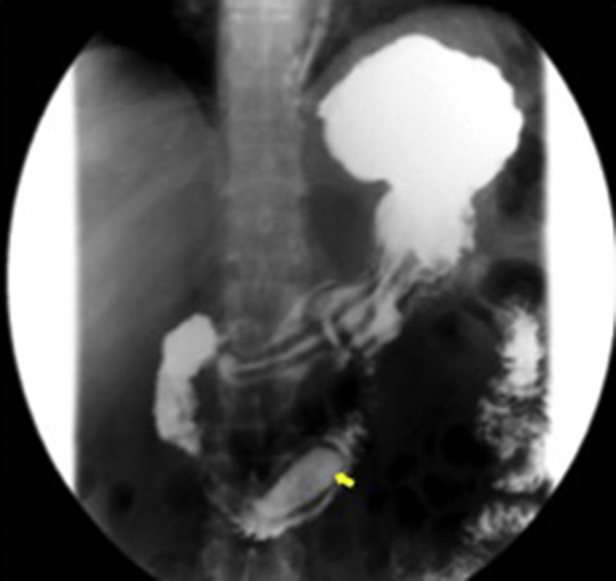 Intraluminal Duodenal Diverticulum A Pictorial Review Of Xray Us Ct