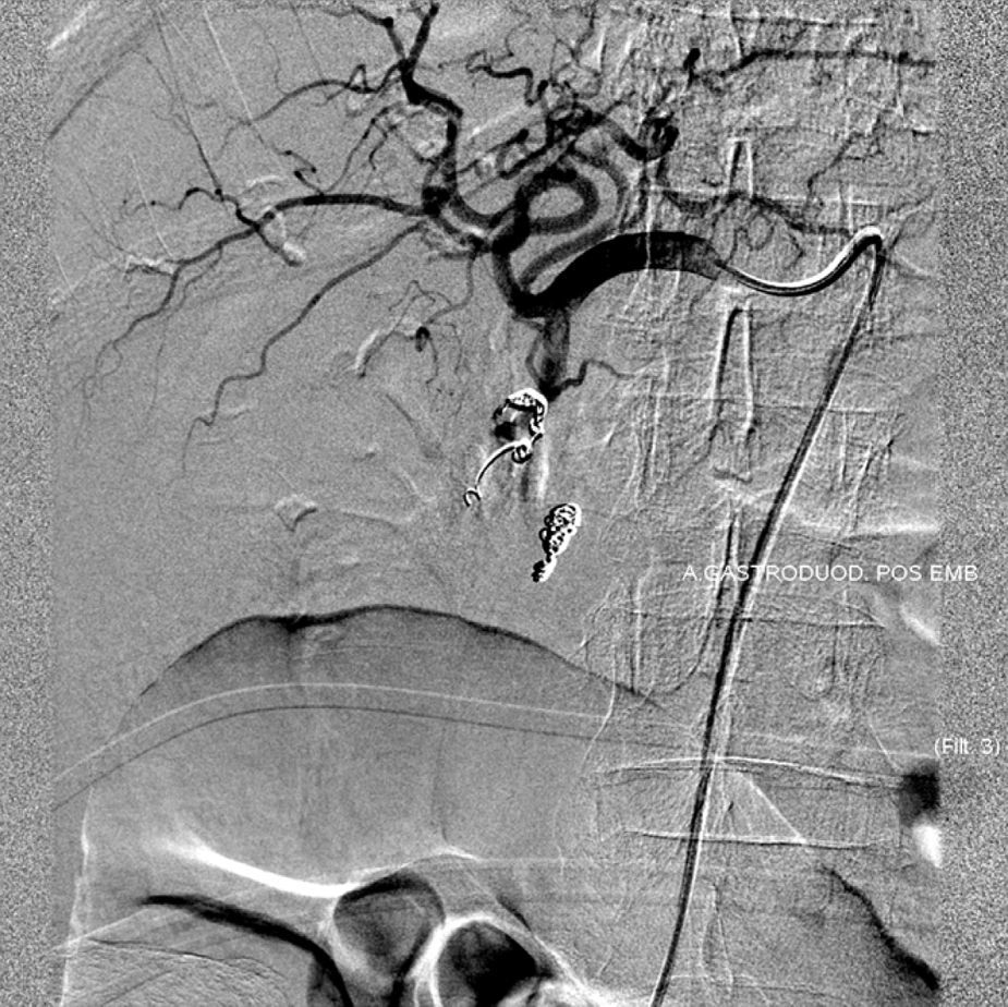 Endoscopic View of Embolization Coil in a Duodenal Ulcer | GE ...