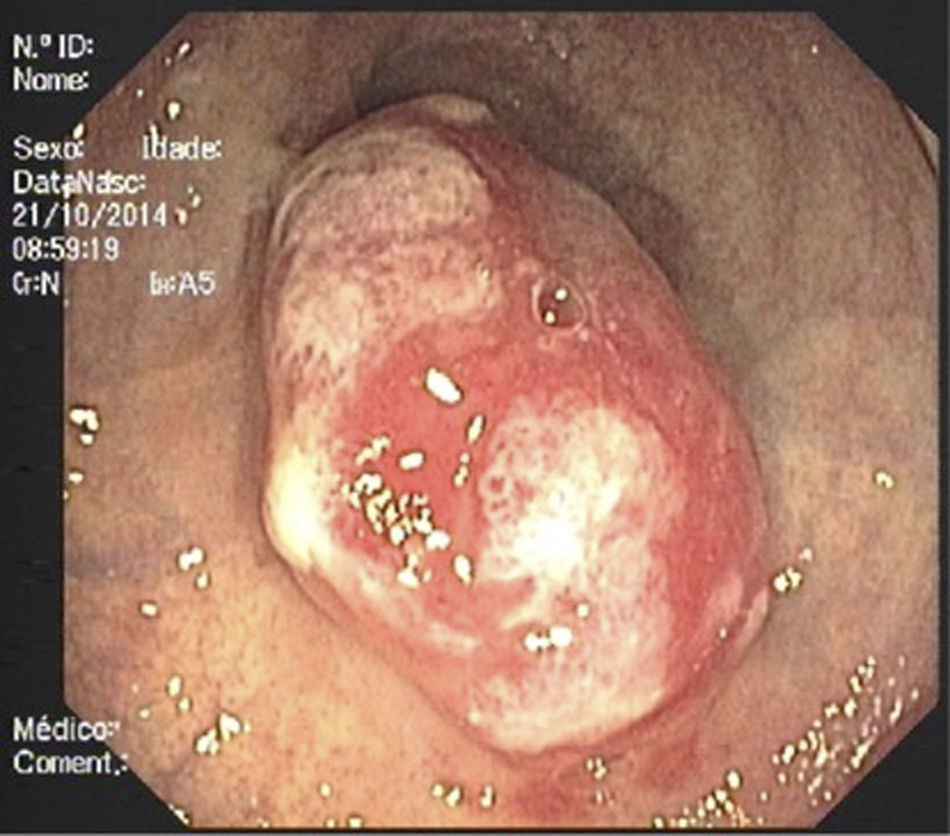 partial rectal prolapse