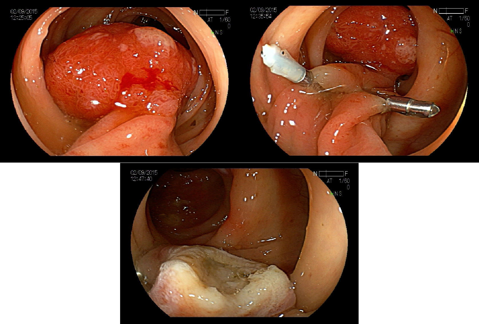 pedunculated polyp 20mm