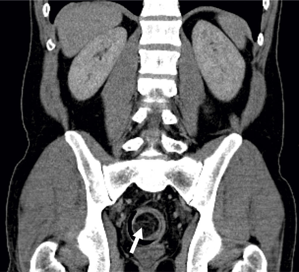 Colonic Intussusception Caused by Colonic Lipoma | GE - Portuguese ...
