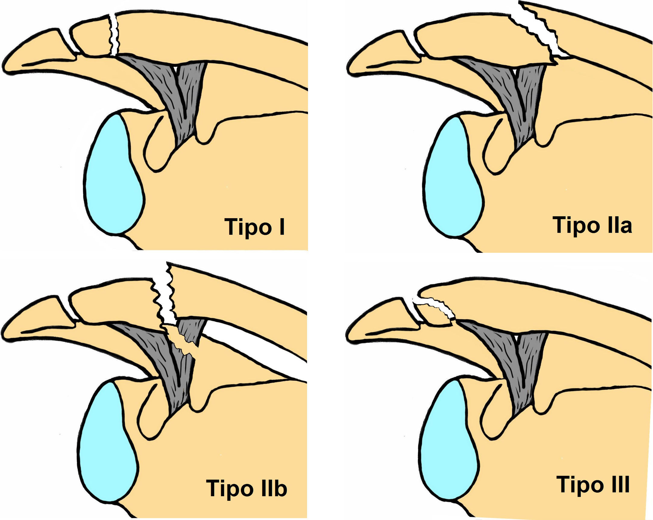Fracturas de clavícula distal | Revista Española de Artroscopia y ...
