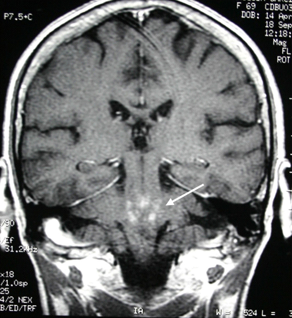 Chronic lymphocytic inflammation with pontine perivascular enhancement ...