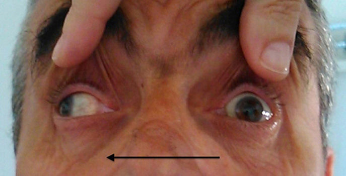 Percheron artery syndrome | Medicina Clínica (English Edition)