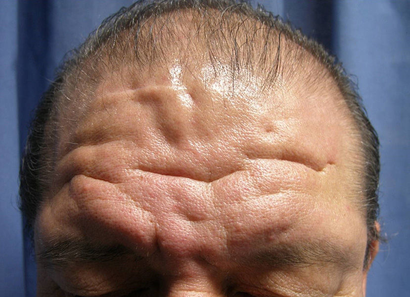 Cutis verticis gyrata associated with Klinefelter syndrome | Medicina ...