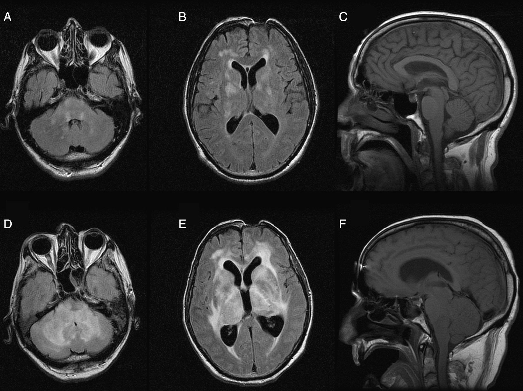Central neurogenic hyperventilation in a patient with post-vaccination ...