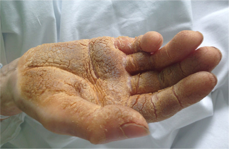 Unna-Thost syndrome | Medicina Clínica (English Edition)