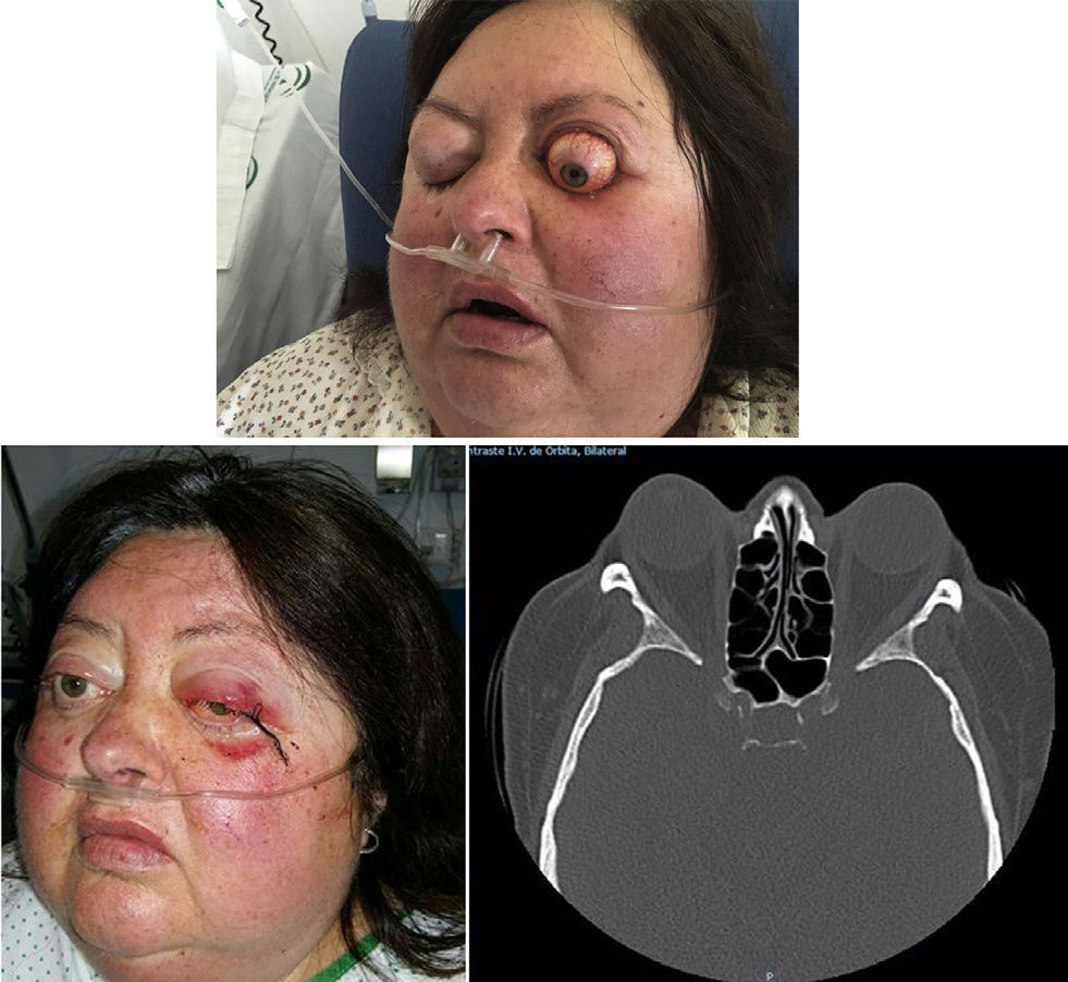 Palpebral anterior eye globe luxation after eyelid retraction ...