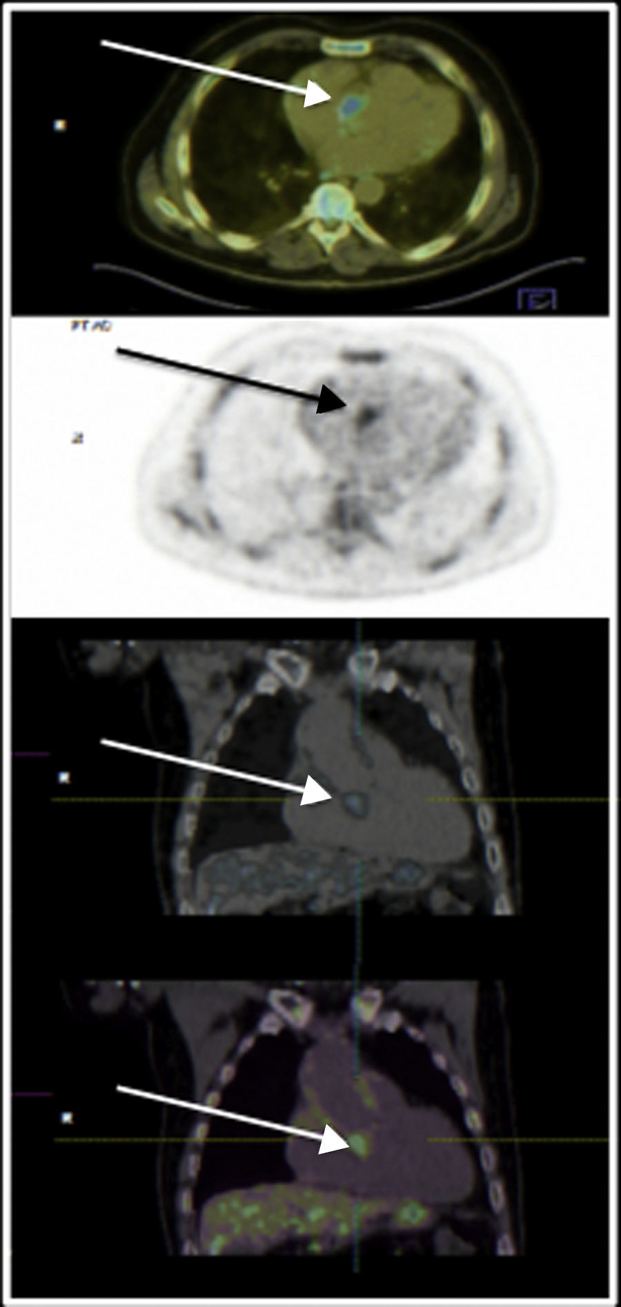 Diagnosis of myocardial abscess secondary to infective endocarditis 18F ...