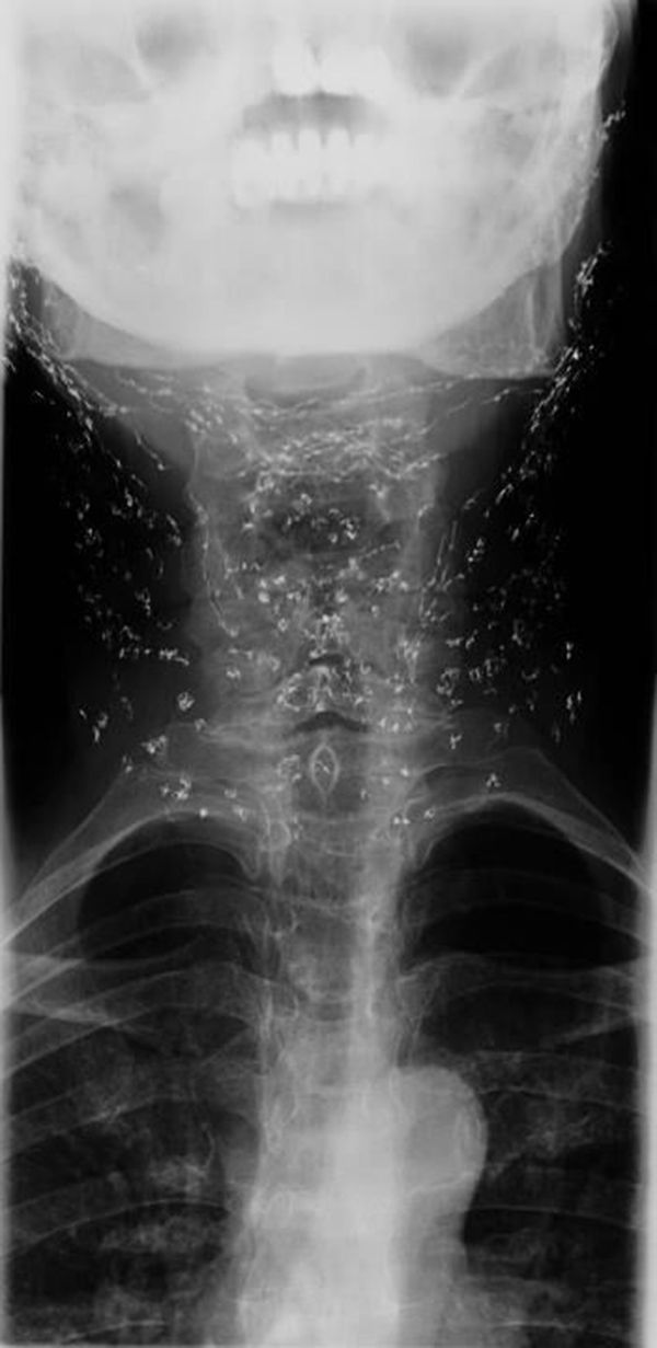 Subcutaneous gold threads in a patient with neck pain | Medicina ...