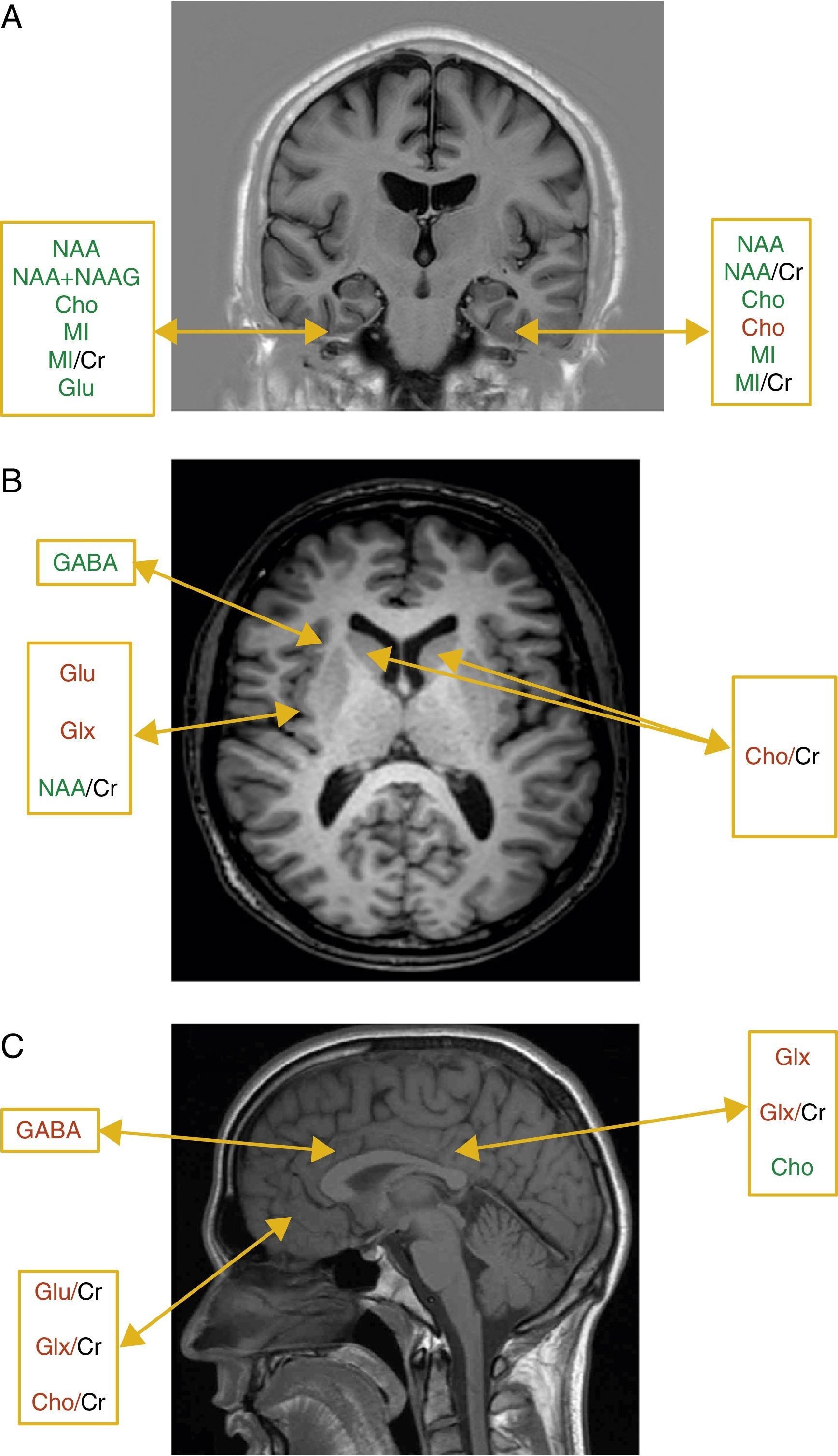 Cerebral magnetic resonance changes associated with fibromyalgia ...