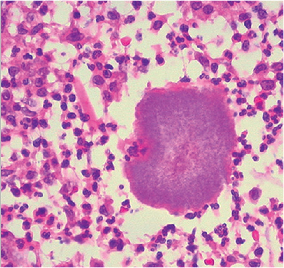 A lumpy jaw | Medicina Clínica (English Edition)