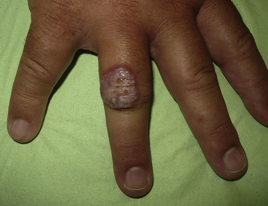 Inflammatory tinea manuum: The importance of pustules | Medicina ...