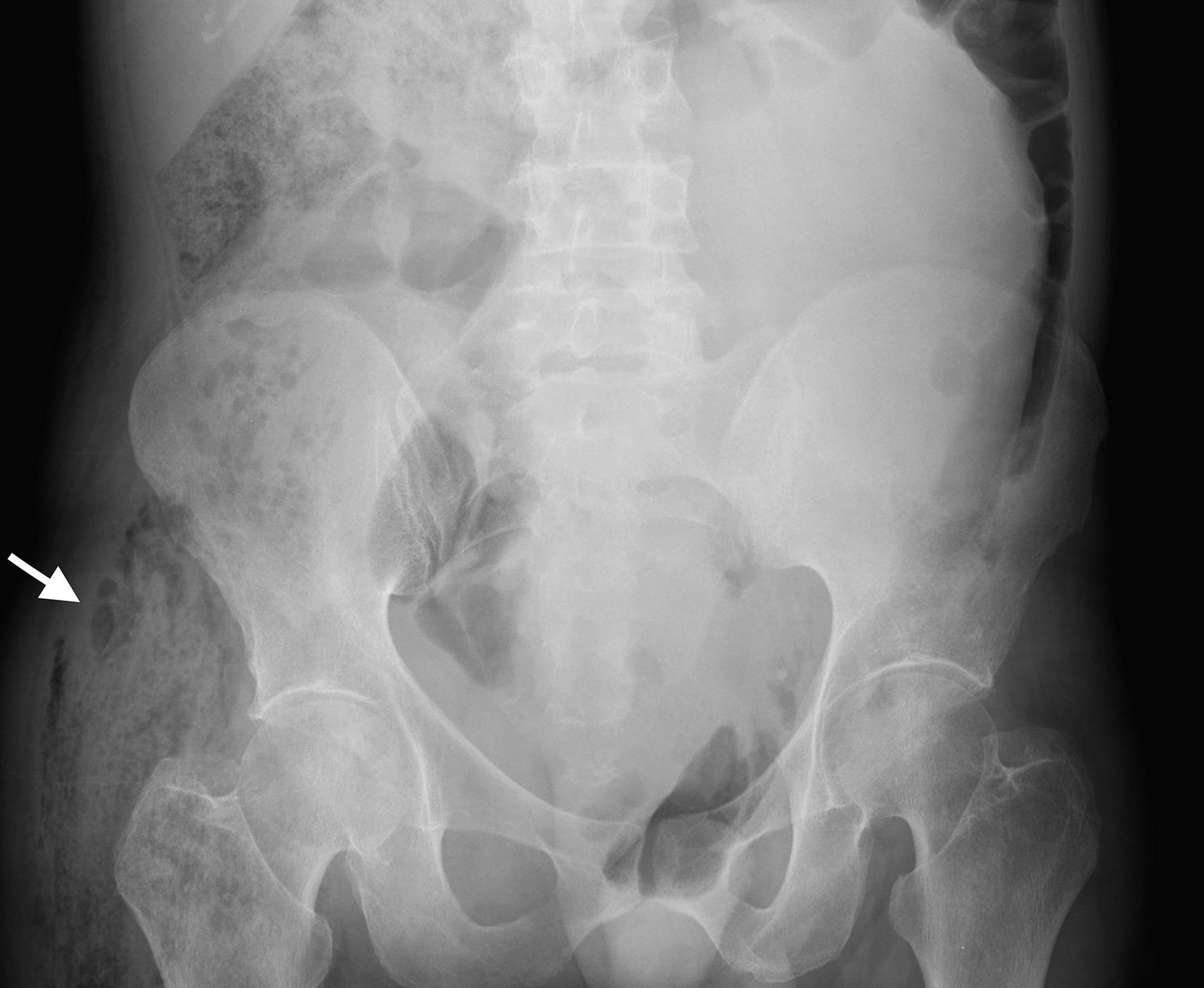 Subcutaneous emphysema of the leg | Medicina Clínica (English Edition)