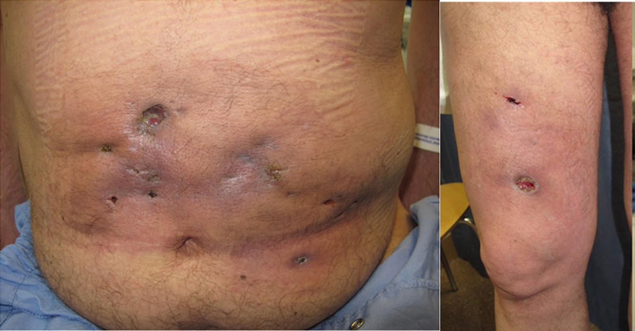 Fat necrosis and subcutaneous abscesses due to apomorphine | Medicina ...