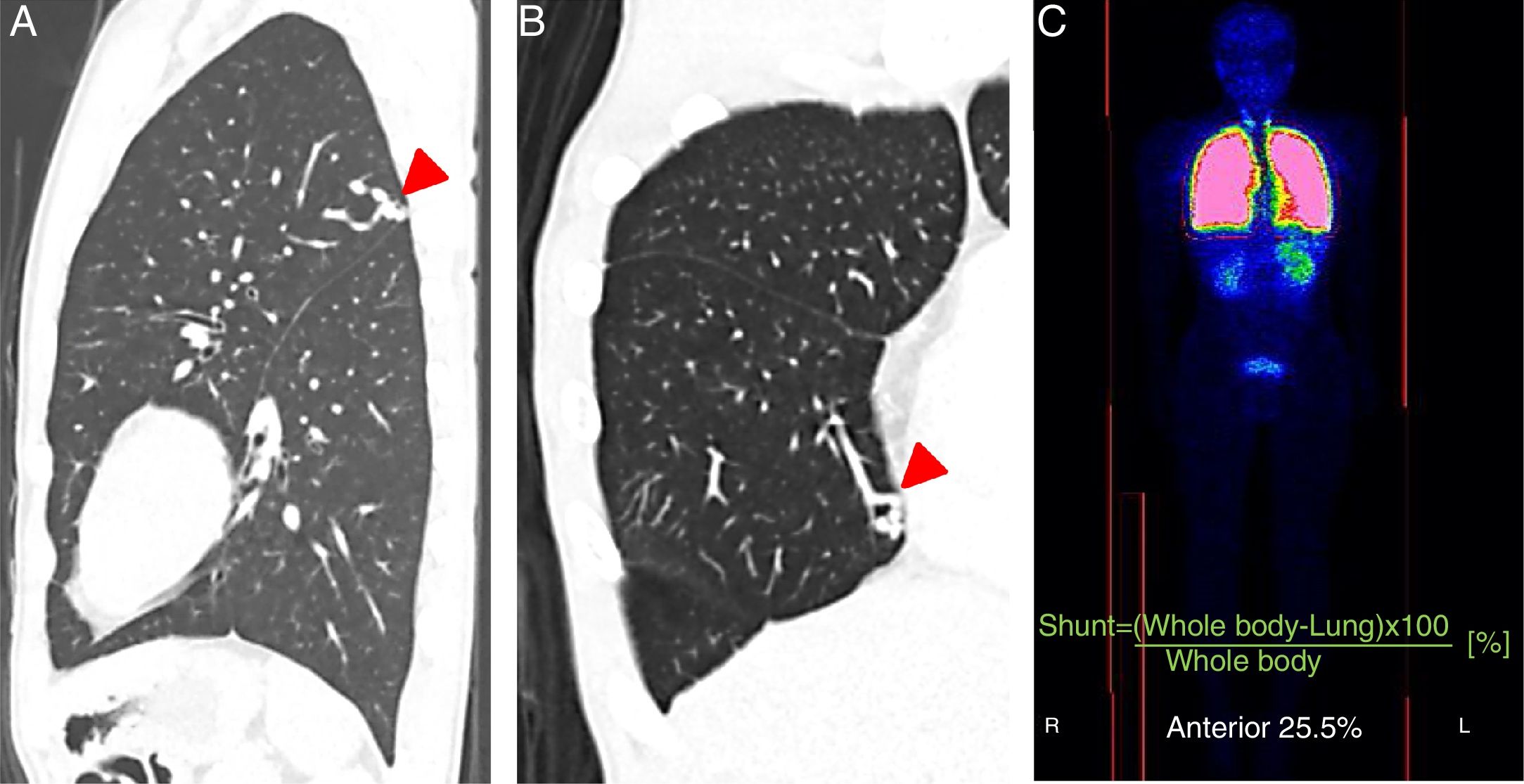Right-to-left pulmonary shunt through arteriovenous malformation ...