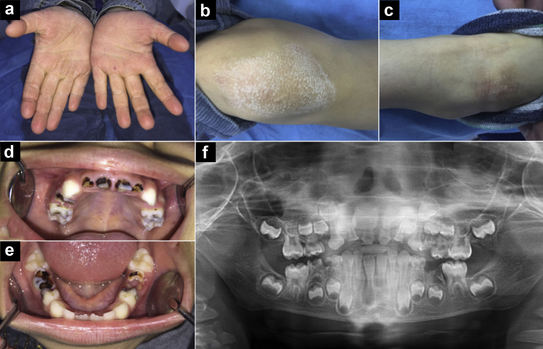 Papillon-Lefevre Syndrome: A case report | Medicina Clínica (English ...