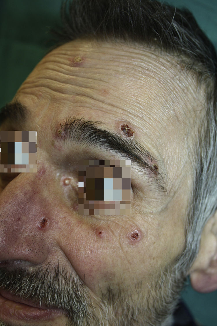 Cutaneous cryptococcosis | Medicina Clínica (English Edition)
