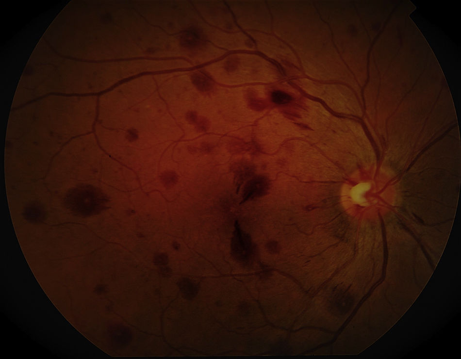 roth spots endocarditis