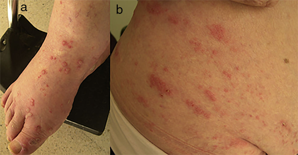 Herpes zoster multiplex: Report on one case | Medicina Clínica (English ...