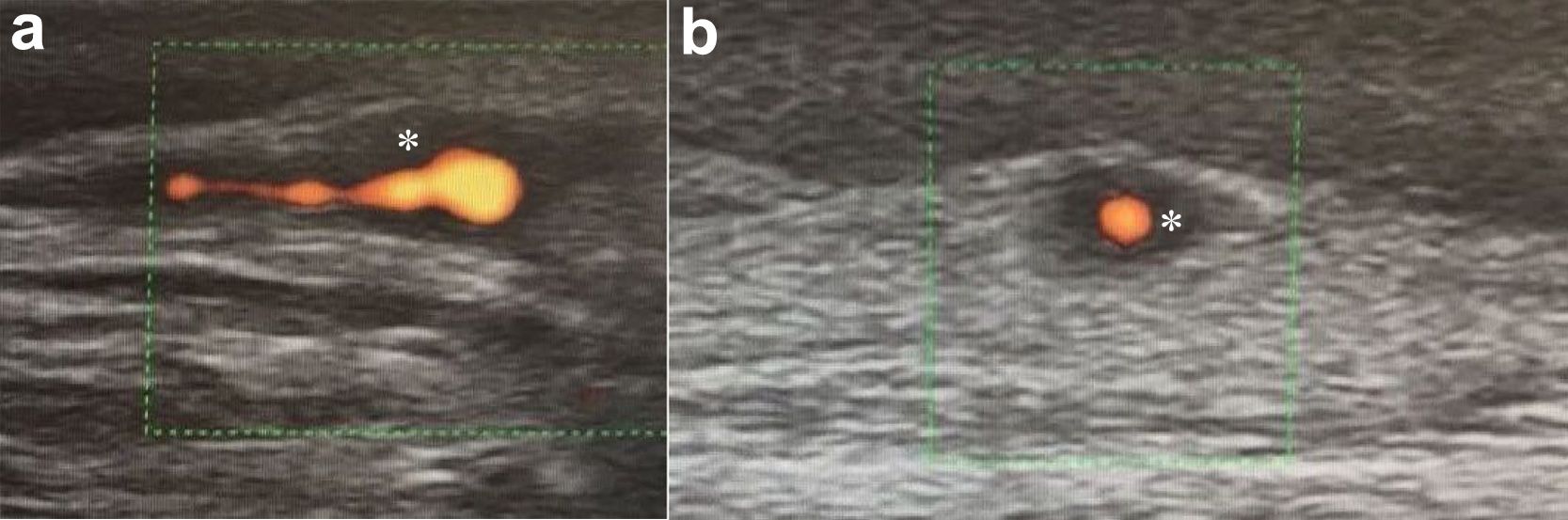 Doppler ultrasonography of superficial temporal artery in a cohort of ...