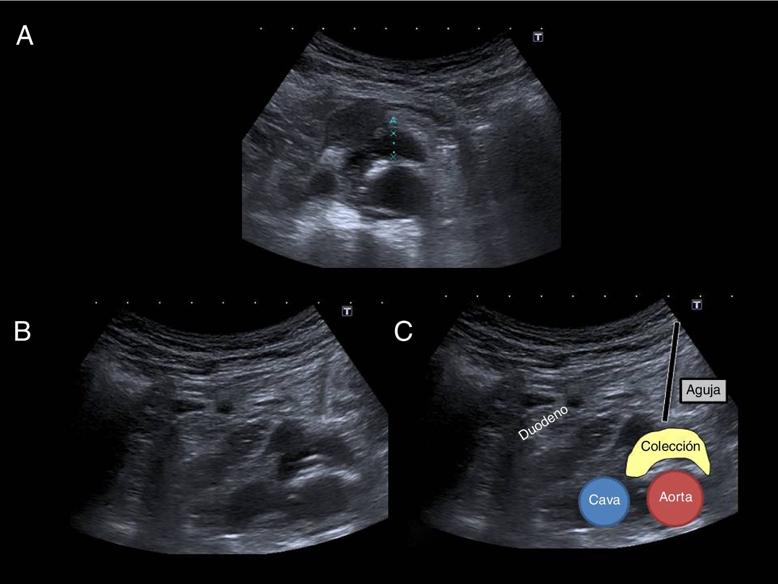 Tuberculous aortitis after intravesical instillation of BCG | Medicina ...