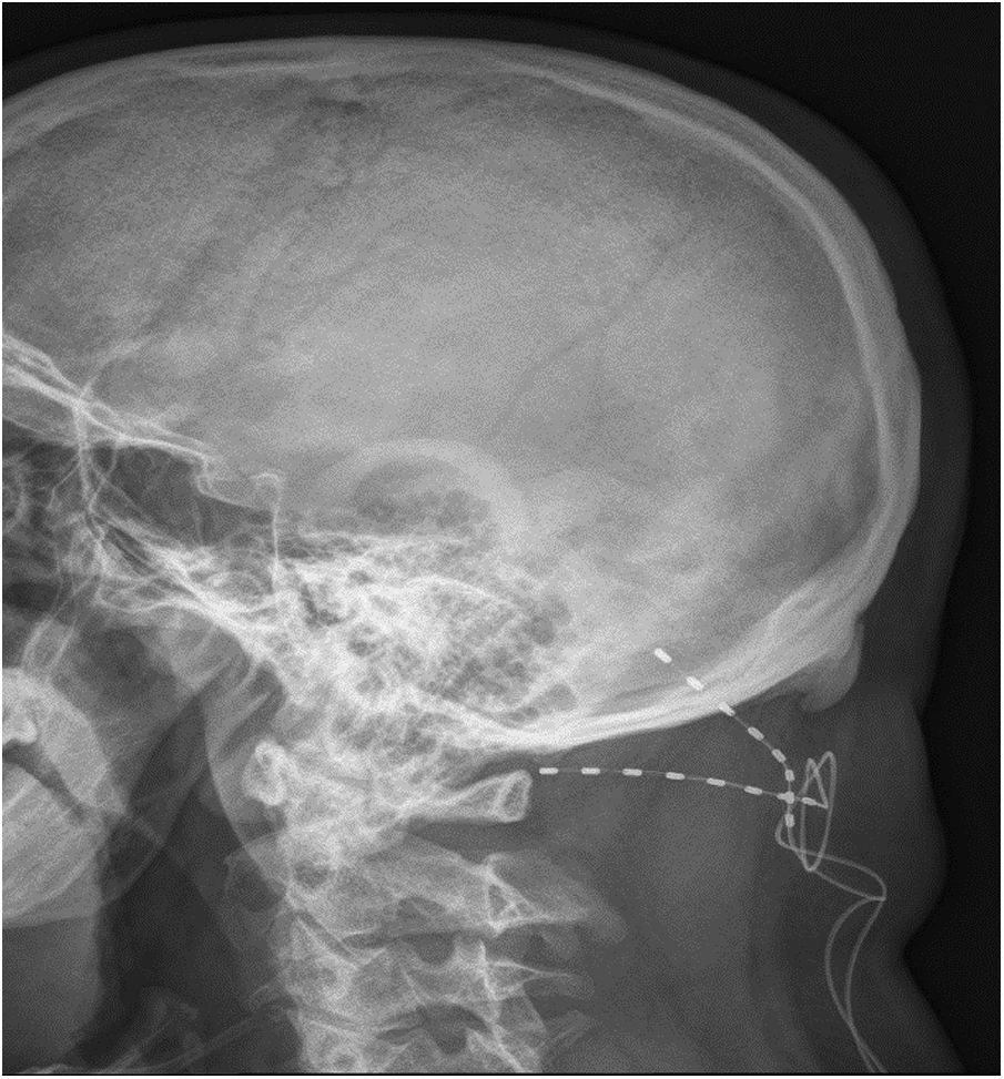 Efficacy and safety of surgical treatment of cluster headache ...