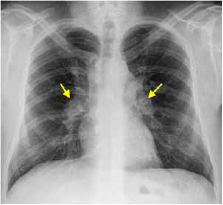 Löfgren syndrome: Report of two cases | Medicina Clínica (English Edition)