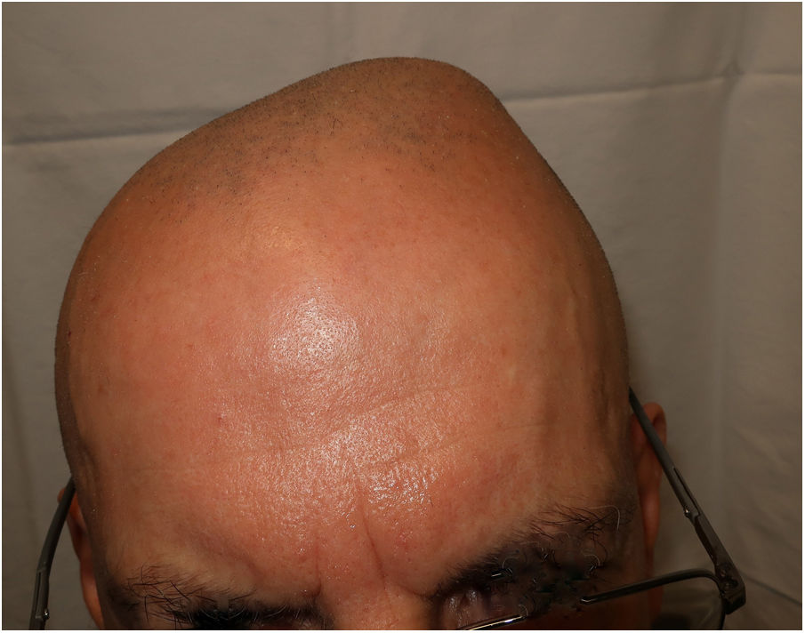 Osteolytic atypical meningioma mimicking lipoma of the scalp | Medicina ...