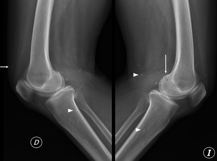 Radiographic findings of metallic foreign bodies due to permanently ...