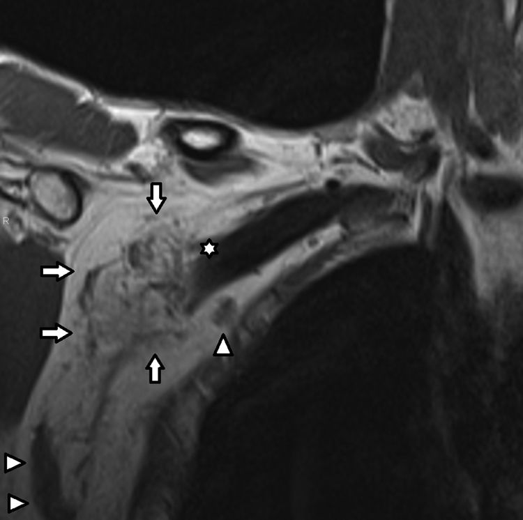 Axillary lymphadenitis associated with a herpes-zoster mimicking a ...