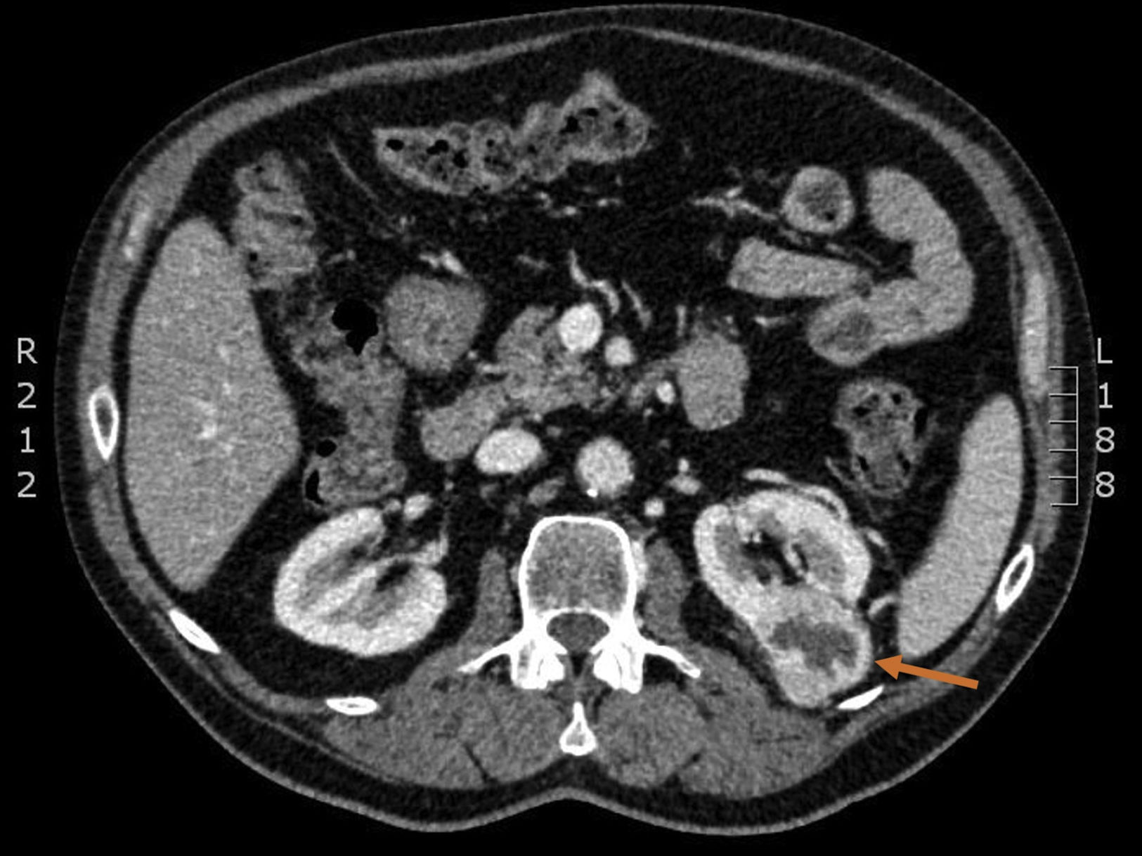 Paraneoplastic erythema annulare centrifugum eruption (PEACE ...