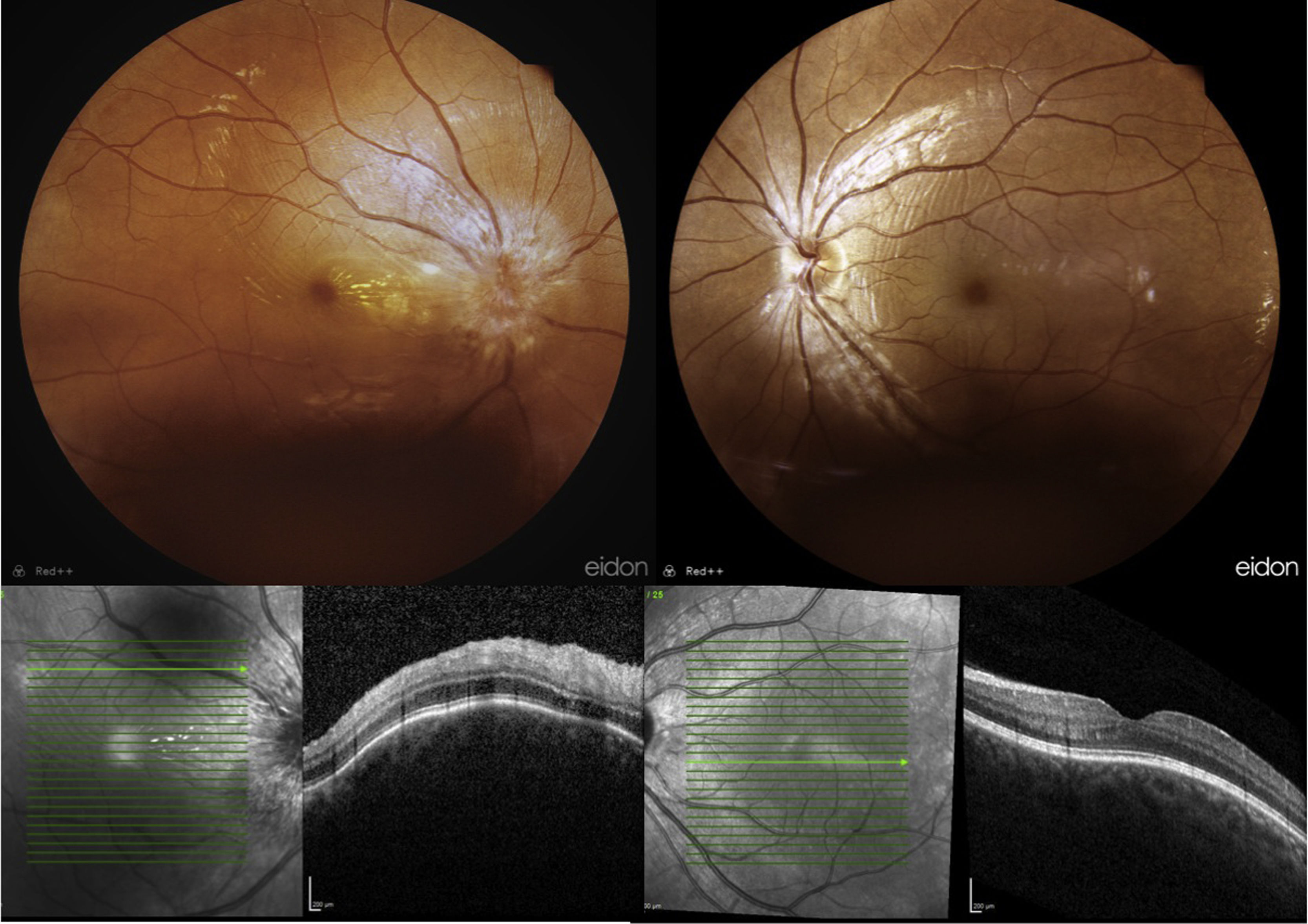Bilateral choroidal tuberculoma and neuroretinitis as the presenting ...