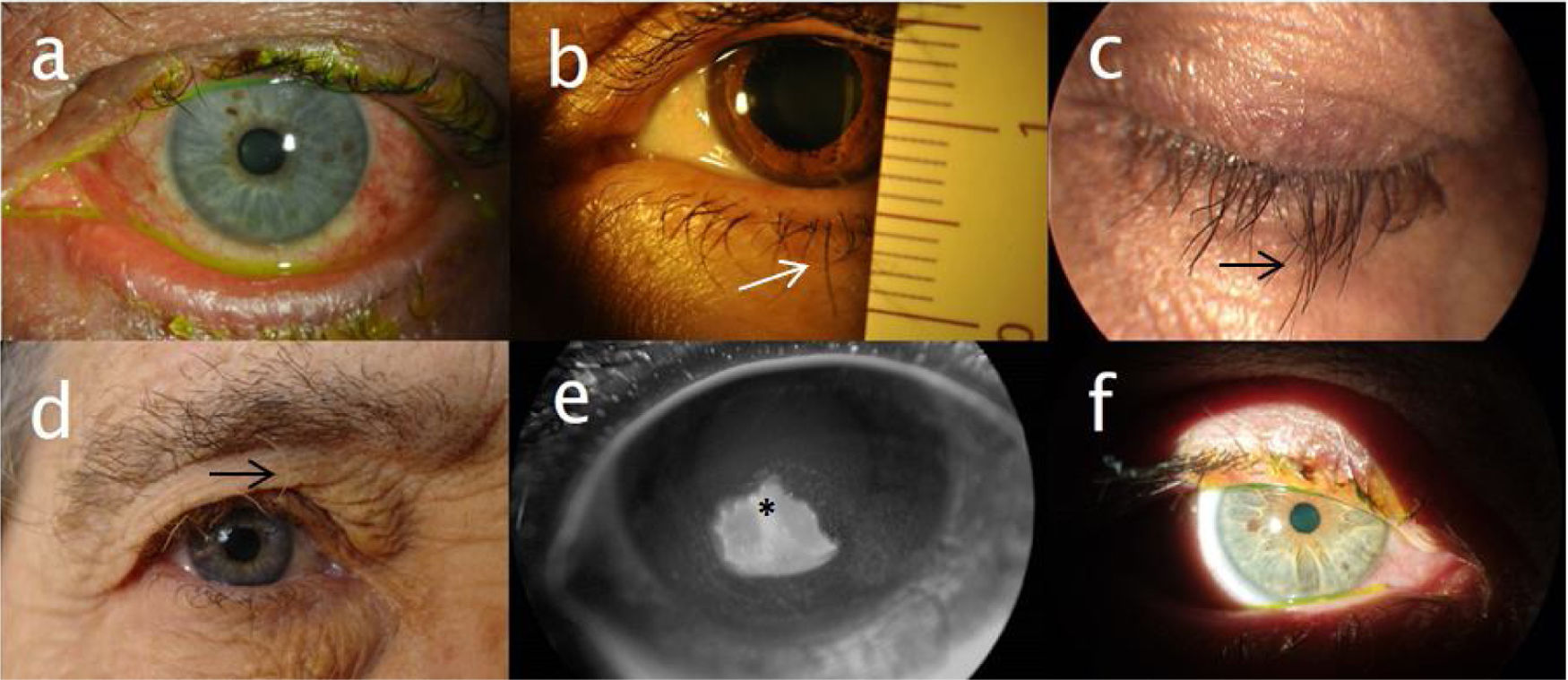 Ocular surface toxicity associated with epidermal growth factor ...