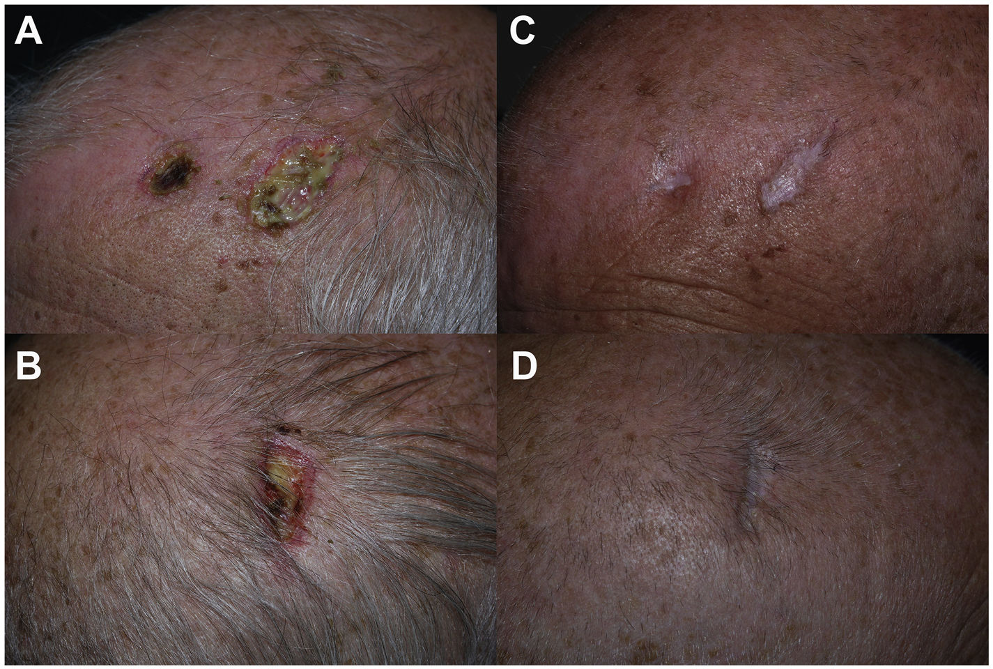 Bilateral scalp ulcers | Medicina Clínica (English Edition)