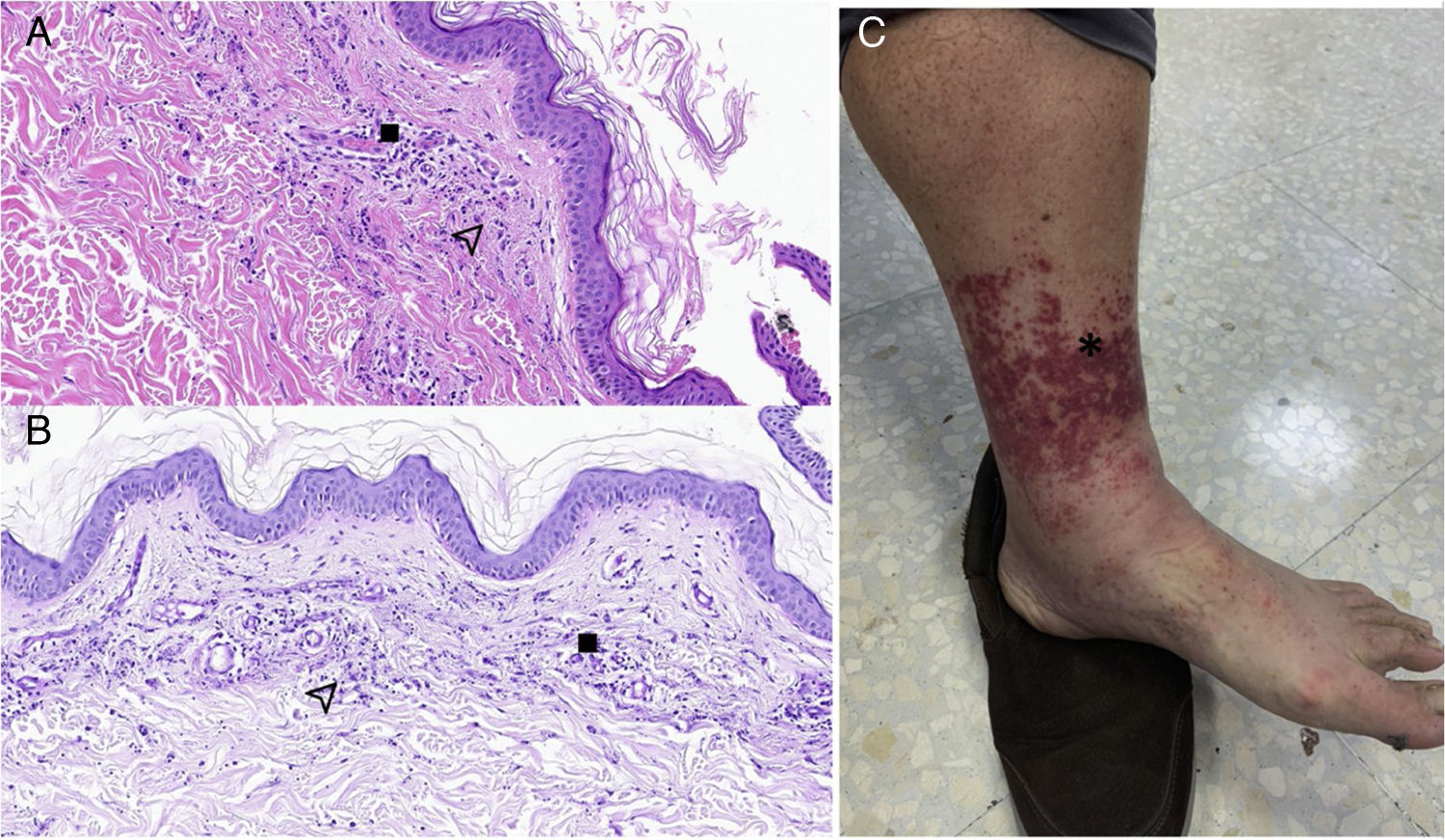 cutaneous vasculitis