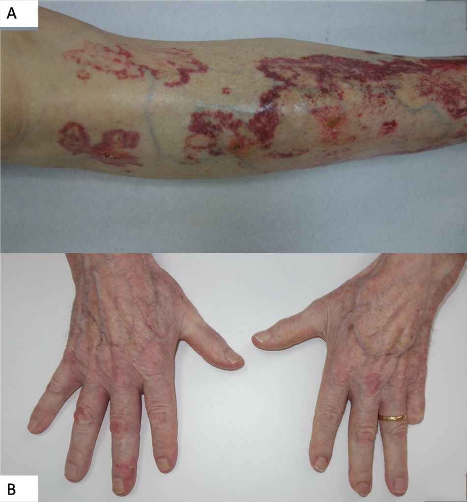 Hand ulcers and cutaneous leucocytoclastic vasculitis secondary to ...