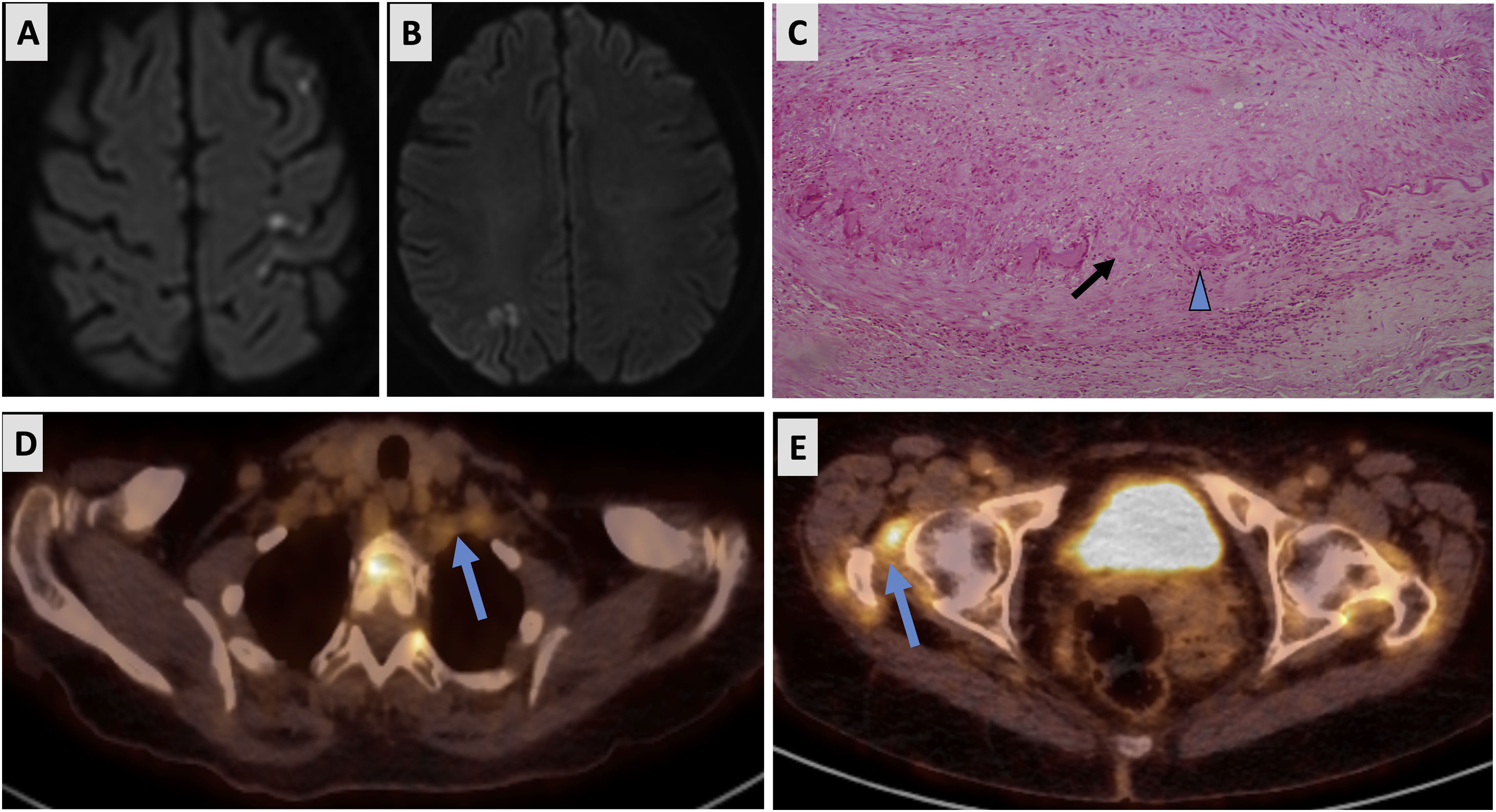 Polymyalgia rheumatica and giant cell arteritis with intracranial ...