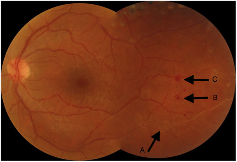 Bilateral retinal vasculitis in association with systemic sclerosis ...